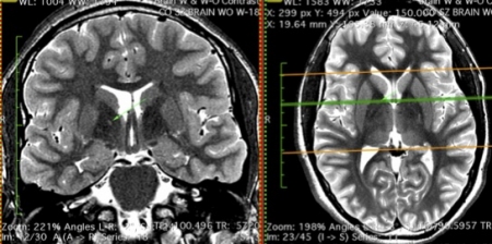 Globus Pallidus Lesion - Carbon Monoxide Poisoning
