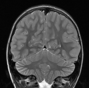 Carbon Monoxide in Children - Carbon Monoxide Poisoning