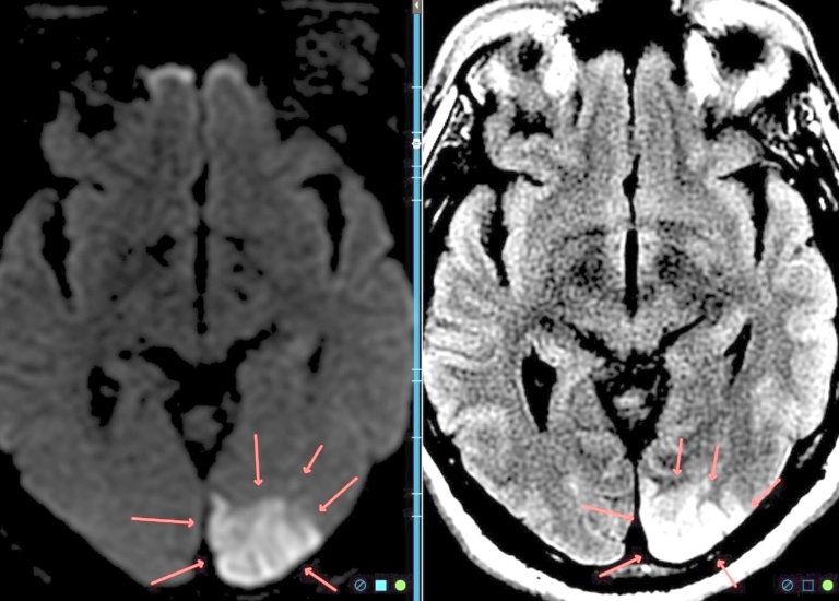 How can you have Permanent Brain Damage from CO after Oxygen levels ...