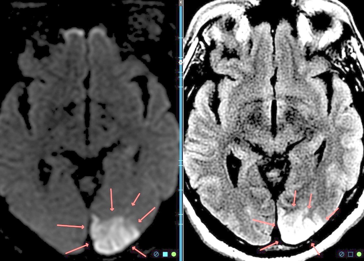 How can you have Permanent Brain Damage from CO after Oxygen levels ...